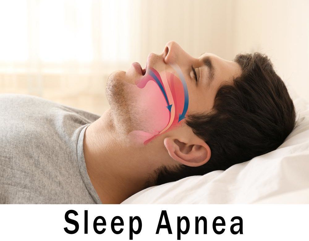 Sleep Apnea Raises Your Risk of Sudden Cardiac Death: Get the Facts