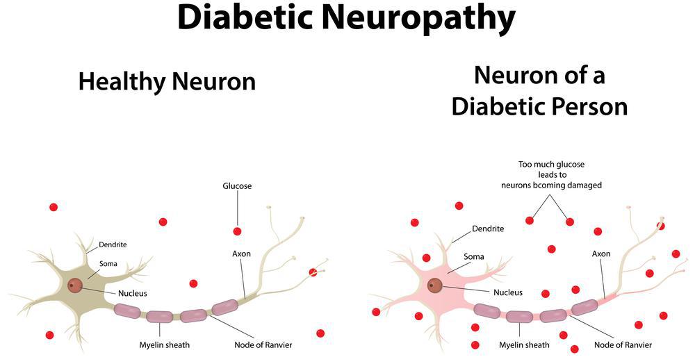 Pain And Sleep Diabetic Neuropathy